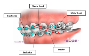 Braces Diagram | Port Coquitlam, British Columbia | Innova Ortho